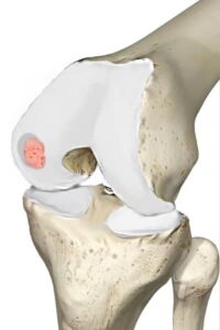La lésion ostéochondrale / l’ostéochondrite du genou - Clinique du genou